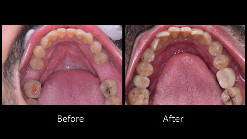 Dental Implants for Missing Molar Teeth – onedayclinic