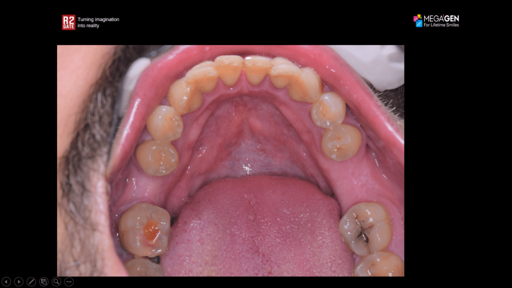 Dental Implants for Missing Molar Teeth – onedayclinic