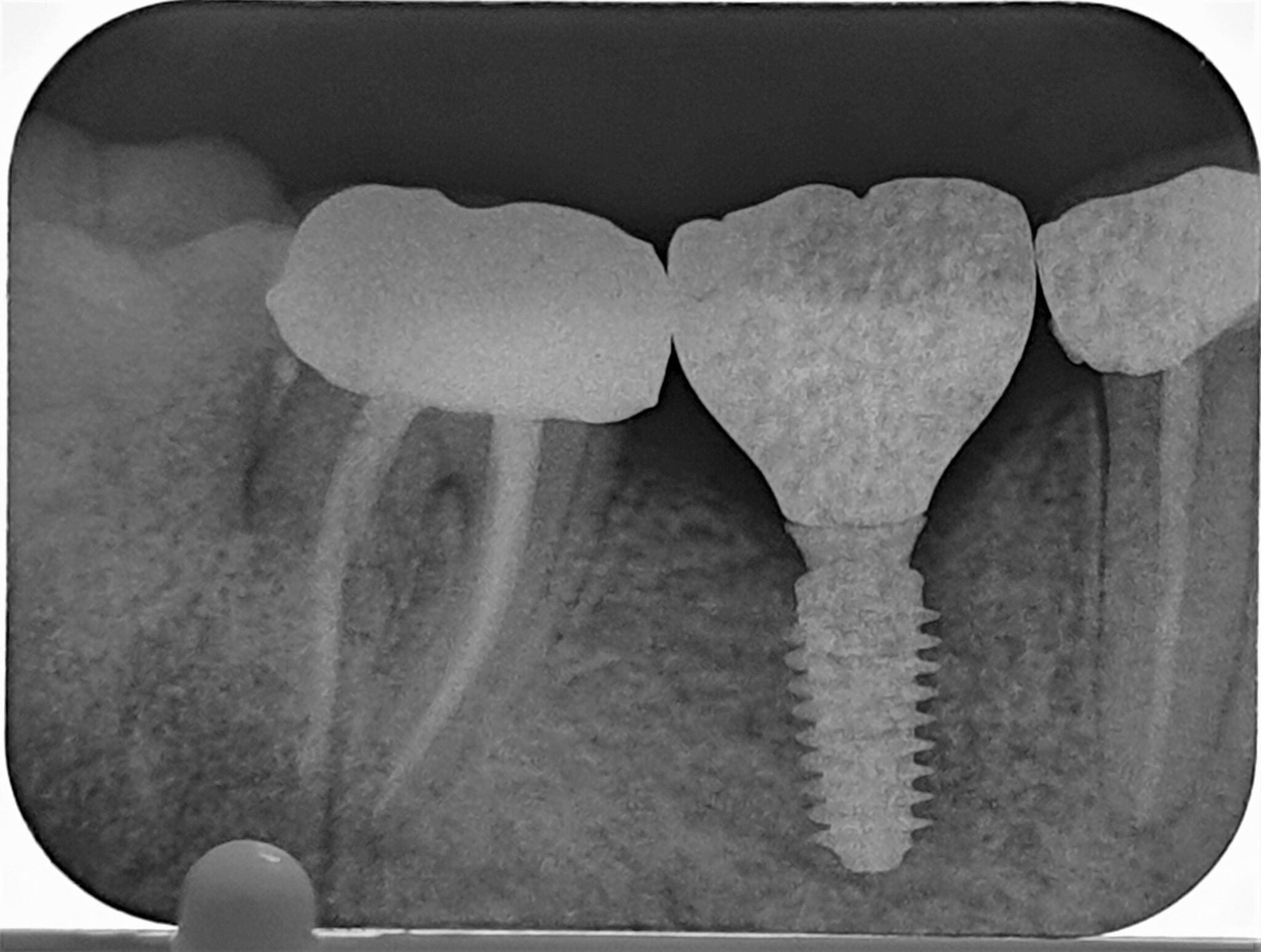 Single Implant in a Molar Tooth – onedayclinic